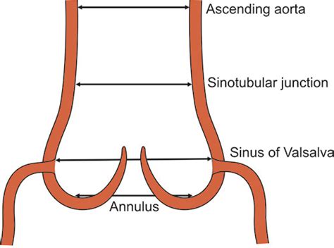 Aortic Sinus