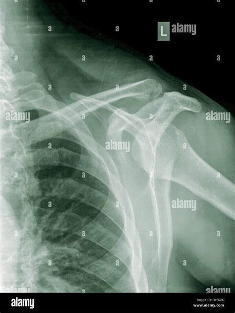Left Clavicle X Ray