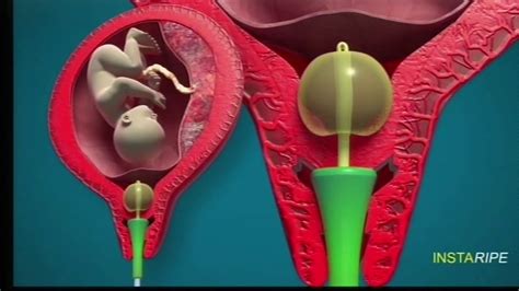 Induction Using Balloon Catheter At Randall Tran Blog