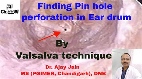 Perforated Eardrum Valsalva At Lois Horning Blog