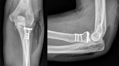 Radial Head Fracture Core Em Olecranon Fracture Broken Elbow Bone