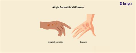 Atopic Dermatitis Vs Eczema Cracking The Itchy Code Knya