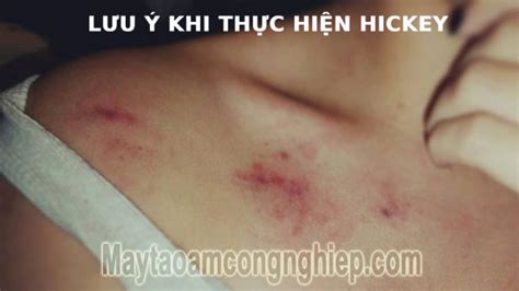 Hickey Là Gì Những Nguy Hiểm Của Hickey Và Cách Nhanh Tan Hickey