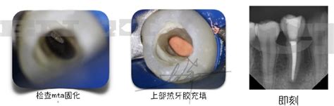 根尖孔未闭合？试试根尖屏障术！ 德医医学 助力医学教育发展！