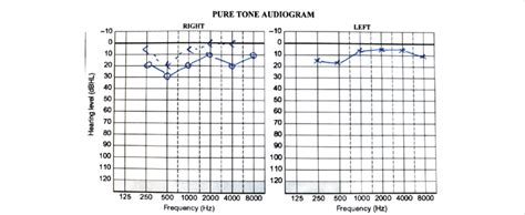 Pure Tone Audiogram Of The Client On The First Visit Download Scientific Diagram