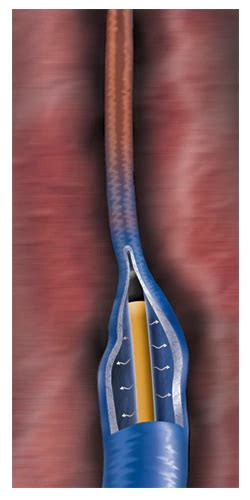 Radiofrequency Ablation Rfa Varicose Veins Treatment