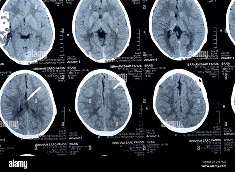 Cairo Egypt September 17 2024 Brain Ct Scan Reveals Left Shunt Tube
