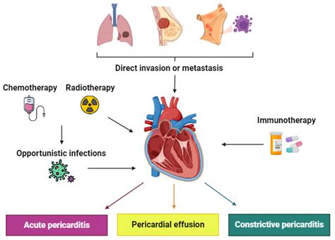 Pericardial Disease In Patients With Cancer Clinical Insights On