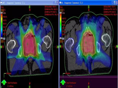 The Vmat Vs Other Recent Radiotherapy Techniques Pptx