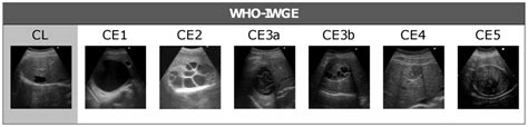 Who Iwge Ultrasound Classification Of Echinococcal Cysts Ce1 And Ce2
