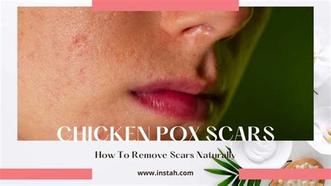 Remove Deep Chicken Pox Scars Naturally Cream And Ointments