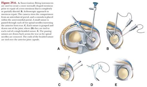 Surgical Techniques For Treatment Of Symptomatic Discoid Meniscus