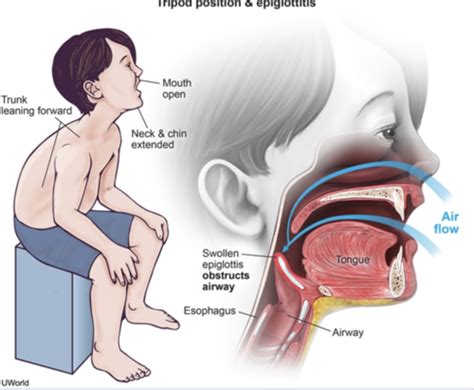 W1 Difficulty In Breathingneonatal Journey Flashcards Quizlet