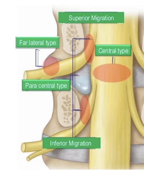 Lateral Disc Herniations Nspc Brain And Spine Surgery
