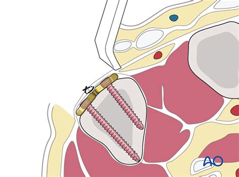 Dorsoulnar Approach To The 5th Metacarpal Base
