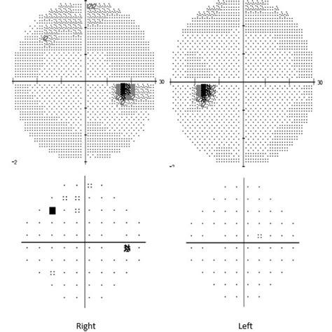 Humphrey Visual Field Grayscale Map And Pattern Deviation Of The Right Download Scientific