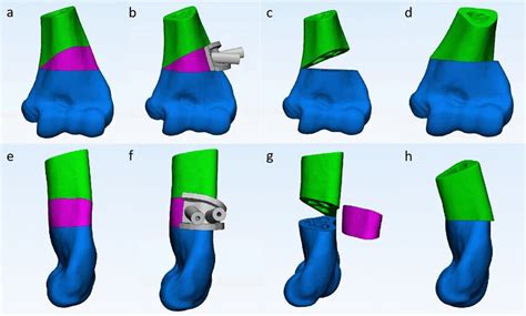 Osteotomy Simulation With 3d Printing Template And The Process Of