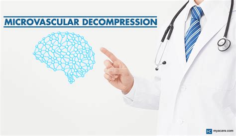 Understanding Microvascular Decompression Treating The Root Of Nerve