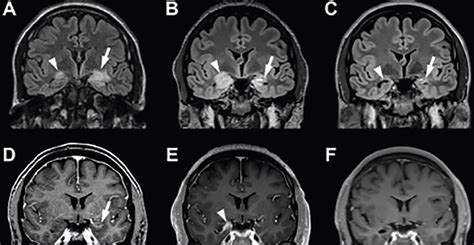 Autoimmune Associated Epilepsy