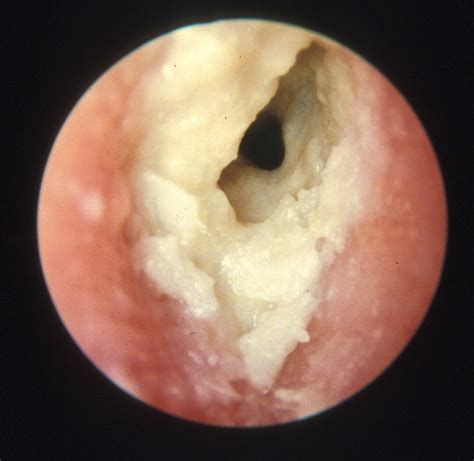 Acute Otitis Externa —