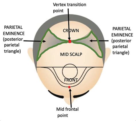 Esthetic Importance Of Parietal Eminence Area Posterior Parietal