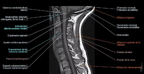 Resonancia Cerebral Normal Todo Lo Que Debes Saber Sobre La Rm En Los