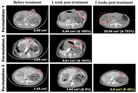 Ct Scan Images Present The Tumors Before Treatment And At Different