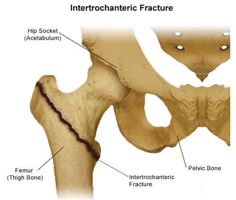 Lateral Femoral Wall Thickness A Reliable Predictor Of Post Operative Lateral Wall Fracture In