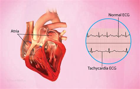Paroxysmal Atrial Tachycardia How It Happens