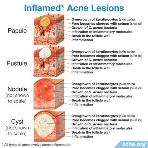 What Is The Difference Between Inflamed And Non Inflamed Acne