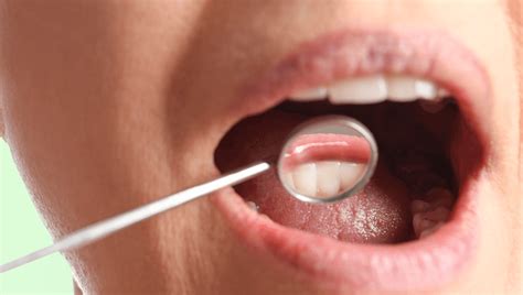 Papillitis Op De Tong Wat Betekenen Deze Kleine Pijnlijke Bultjes Myvariations