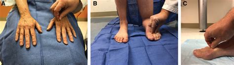 内科医になろう リンパ浮腫に対するstemmer Sign