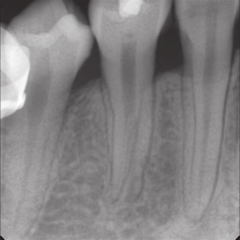 Formation Dentin Bridge On The Periapical Radiograph Download