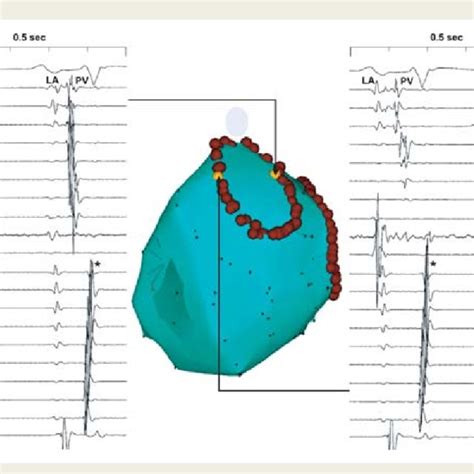 Mapping And Ablation Of Two Remaining Conduction Gaps After Anatomical
