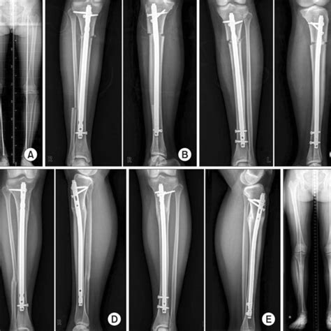 Pdf Corrective Tibial Osteotomy In Young Adults Using An Intramedullary Nail
