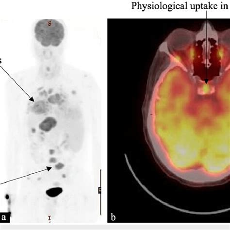 Histology A Thyroid Specimen Showing Nuclear Features Of Ptc Arrow