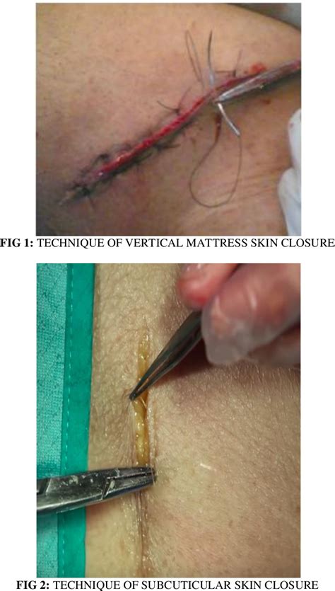 Subcuticular Suture