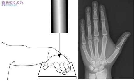 X Ray Of Hand Anatomy
