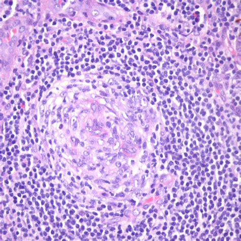 Lymphnodebiopsyfolliclewithsmallgerminativecenterandexpansion Of The Download Scientific