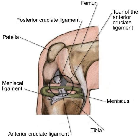 FOCUS ON ACL RECONSTRUCTIONS