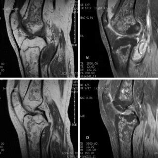 Mri Showing Multiple Soft Tissue Abscesses Formed Around The Knee A
