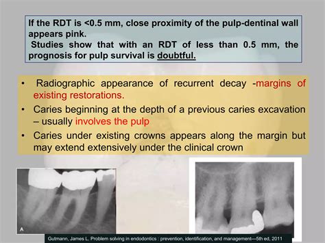Clinical Diagnosis Of Endodontic Pathosis Ppt