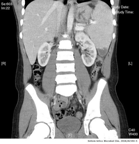 Splenic Infarction Due A Common Infection Enfermedades Infecciosas Y