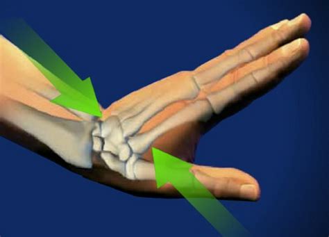 Fractura De Smith O Fractura De Colles Reversa Causas Síntomas Cirugía Del Tratamiento Pt