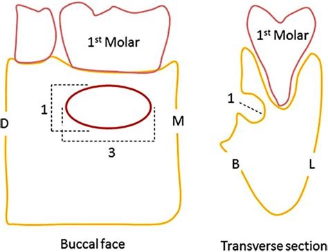 Fig Ure 1 Bone Defect Buccal Face And Transverse Section Of The