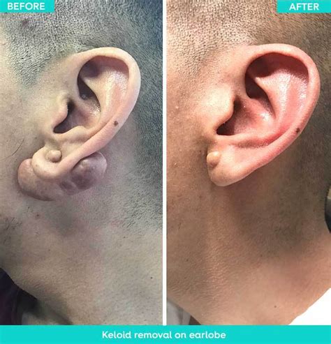 Miami Keloid Removal And Treatment Arviv Medical Aesthetics