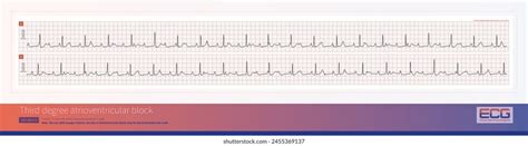 Third Degree Atrioventricular Block Young Women Stock Illustration