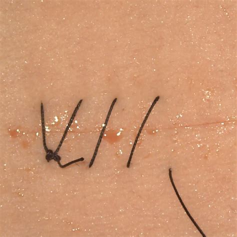 Simple Running Suture Technique How To Master It Upsurgeon