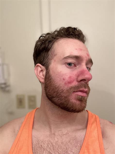 Dermol 500 R Rosacea