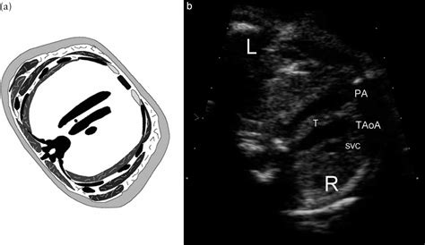 The Role Of The Three Vessels And Trachea View 3vt In The Diagnosis
